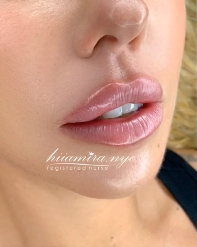 Russian Lip NYC, Lip Augmentation, Lip Enhancement - Olga Beauty